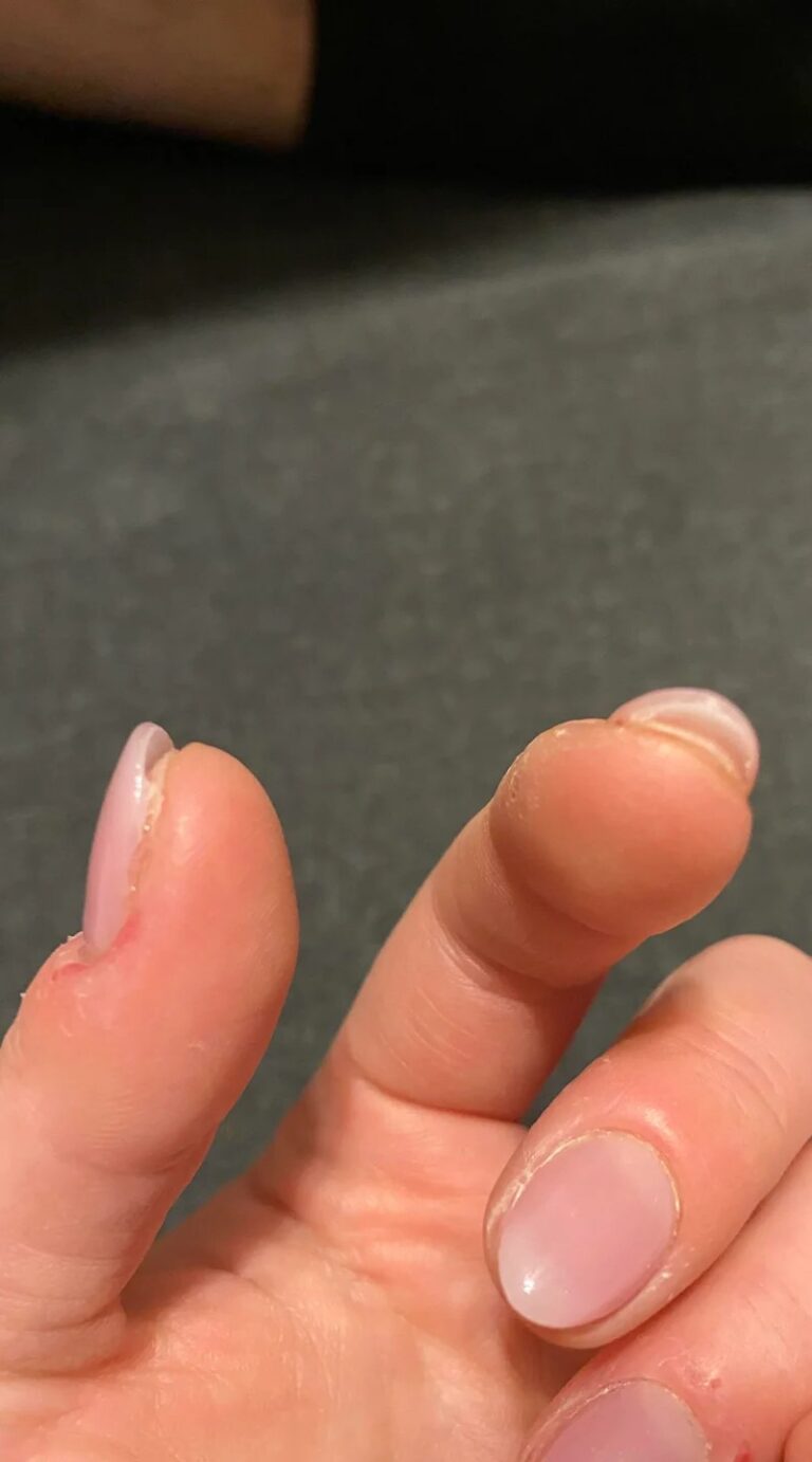 Why Do My Acrylic Nails Lift So Quickly: What's Really Going On (And ...